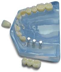 Amazon.com: Upper Arch-Central & 3 unit bridge implant supported ...