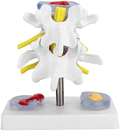 Human Spine Model, Anatomical Lumbar Disc Herniation Demonstration ...