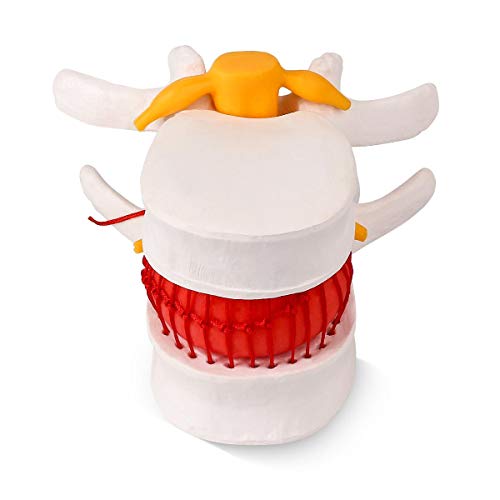 Snapklik.com : MIIRR Human Lumbar Disc Herniation Model, Vertebral ...