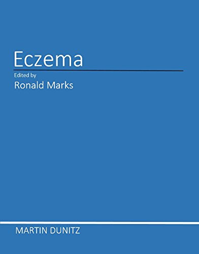 Eczema: Ronald, ed. Marks: 9781853170232: Amazon.com: Books