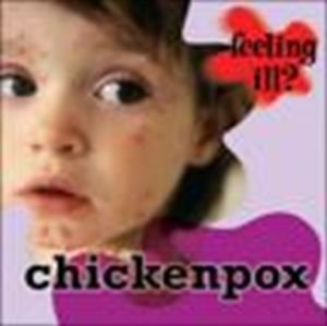 CHICKEN POX : Amazon.in: Books