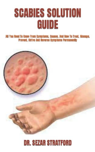 Buy SCABIES SOLUTION GUIDE: All You Need To Know From Symptoms, Causes ...