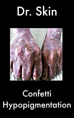 Confetti Hypopigmentation - Kindle edition by Skin, Dr.. Health ...