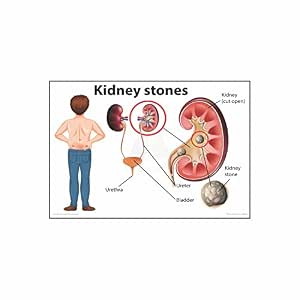 Anne Print Solutions® Kidney stones Posters For Hospital Posters ...