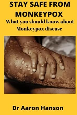 STAY SAFE FROM MONKEYPOX: What You Should Know About Monkeypox Disease: Hanson, Dr Aaron ...