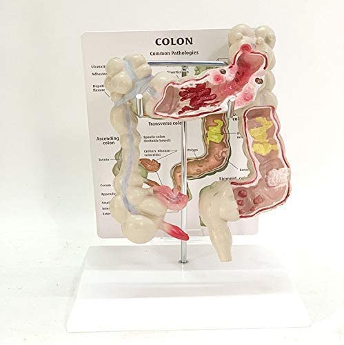 Buy showyow Human Colorectal Lesion Model, Colon Model, Human Body ...