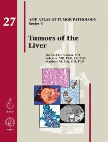 Tumors of the Liver: No. 27 (AFIP Atlas of Tumor Pathology, Series 4 ...