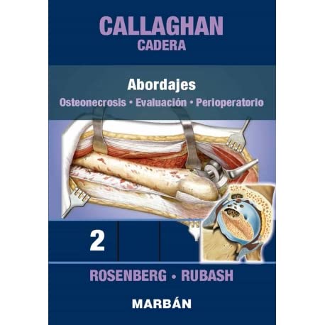 Callaghan Cadera 2: Abordajes. Osteonecrosis. Evaluación ...