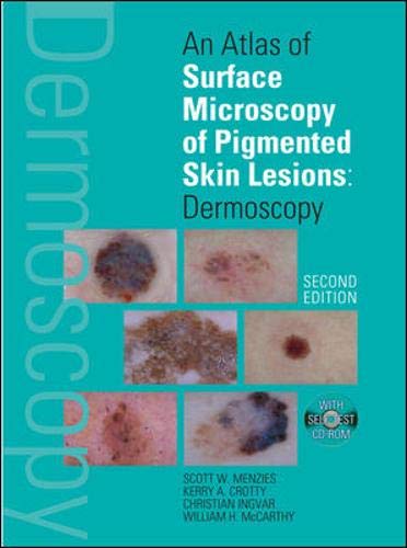 An Atlas of Surface Microscopy of Pigmented Skin Lesions: Dermoscopy ...