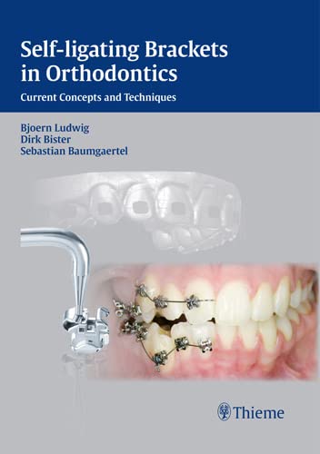 Ebook – Self-ligating Brackets in Orthodontics: Current Concepts and ...