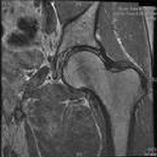 Femoral Neck Fractures Treatment: Amazon.co.uk: Koval, Kenneth J ...
