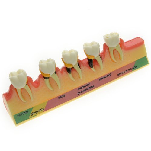 Periodontal Disease Tooth Assorted Typodont Model Of Tooth Model Fabric ...