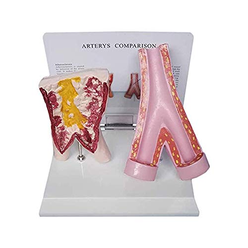 Buy Medical Anatomical Human Blood Vessel Model, Human Atherosclerosis ...