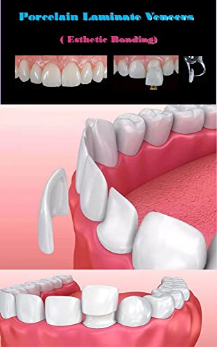 Amazon.com: all ceramic restoration , fixed prothesis , dentistry ...