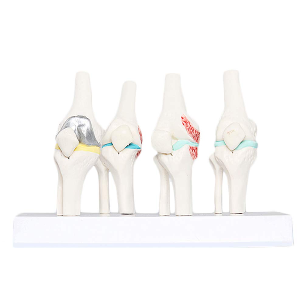 Kh66zky Knee Joint Model Set Of 4 Stage Osteoarthritis Knee ...