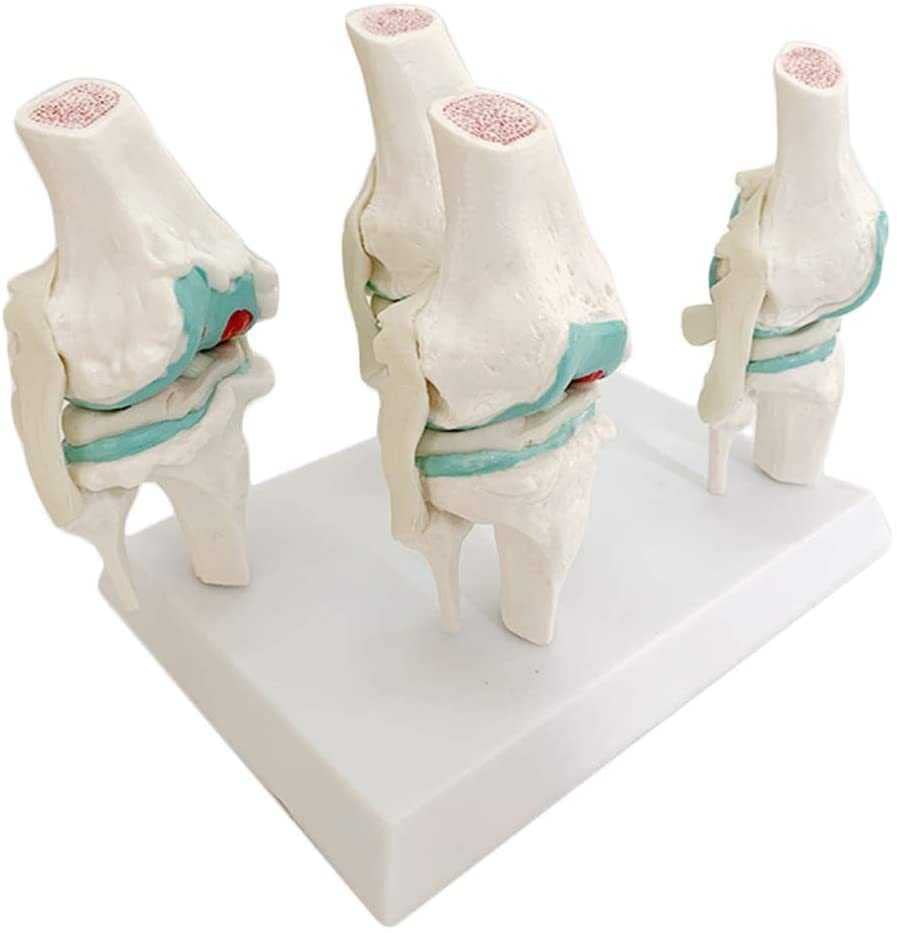 Buy BBYT Knee Joint Model - Four Stages Of Pathological Joints Medical ...
