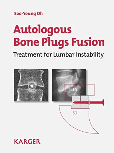 Amazon | Autologous Bone Plugs Fusion: Treatment for Lumbar Instability ...