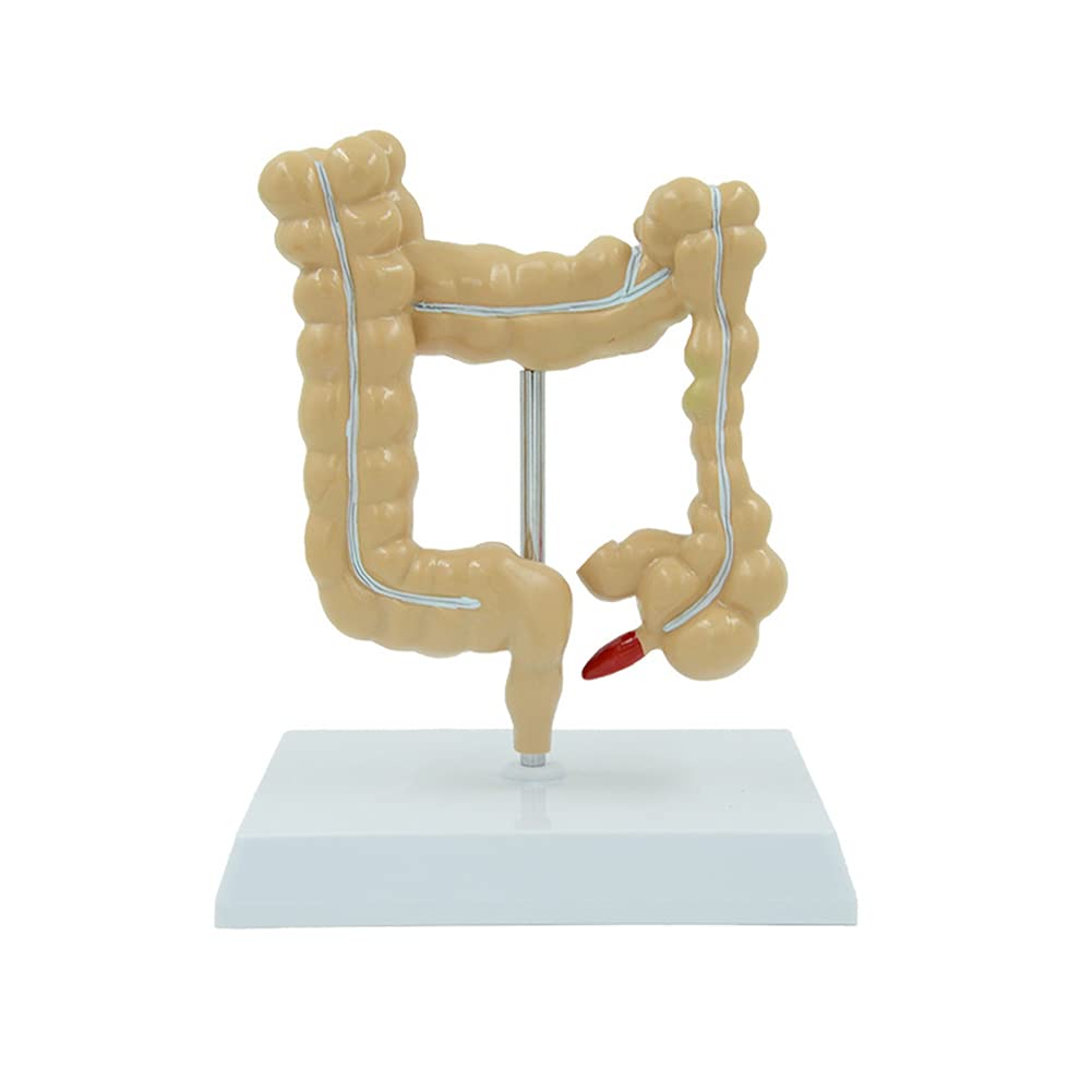 Buy Nlight Human Colorectal Lesion Model Colon Model,Pathological ...