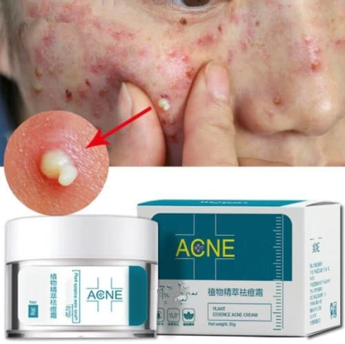 Tratamiento para el acné Crema para eliminar Espinillas Barros Mancha ...
