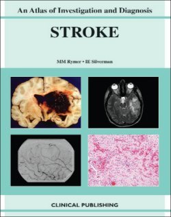 Ischemic Stroke: An Atlas of Investigation and Treatment: 9781846920172 ...