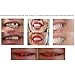 CREADENT Kit for Replacing a Missing Tooth with a Temporary Cosmetic ...