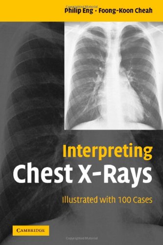 Interpreting Chest X-Rays: Illustrated with 100 Cases: 9780521607322 ...