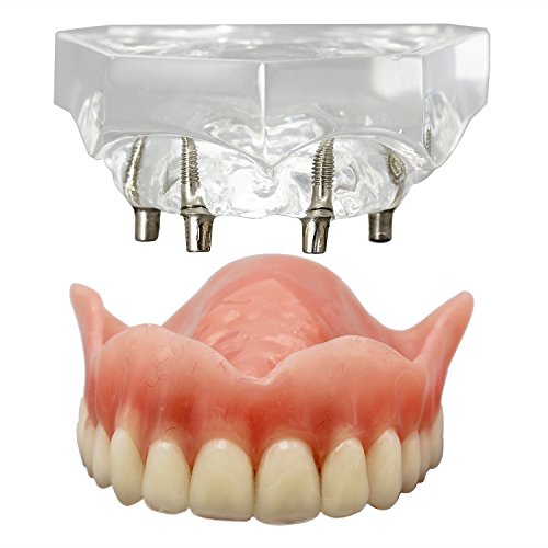Dental Upper Implant Model Overdenture with 4 Superior Teeth - Want It All