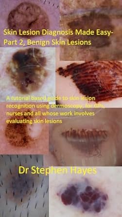 Skin Lesion Diagnosis Made Easy-Part 2, Benign Skin Lesions: A tutorial ...