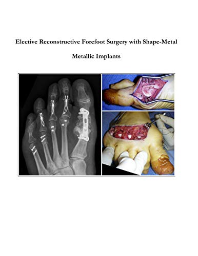 Amazon.com: Elective Reconstructive Forefoot Surgery with Shape-Metal ...