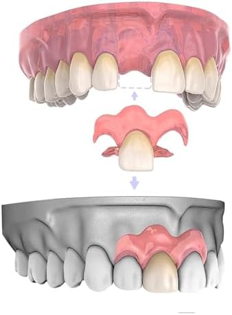 Amazon.com: Partial Dentures for Women & Men, Custom Replacement ...
