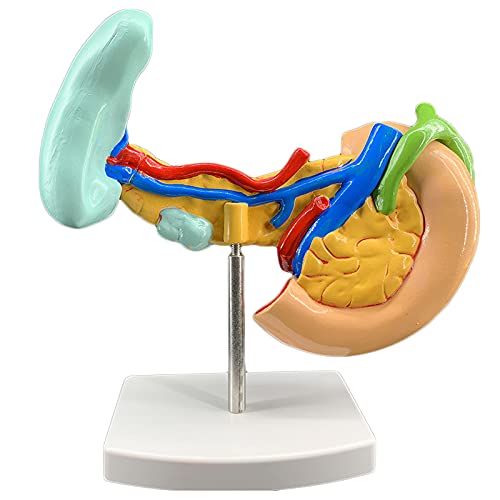 Buy FHUILI Duodenum Model - Human Organ Anatomy Model Diseased Pancreas ...