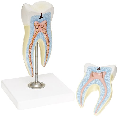 EISCO Upper Triple Root Molar with Caries Model, Enlarged 15 - Want It All