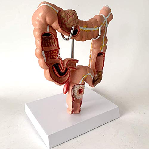 Dlpppa Human Large Intestine Anatomical Model Visceral Lesion Model ...