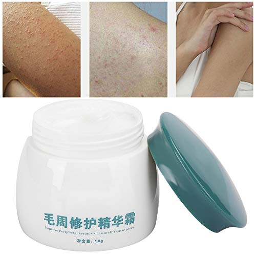 Keratosis Pilaris Cream, Keratosis Pilaris Treatment, Chicken Skin ...