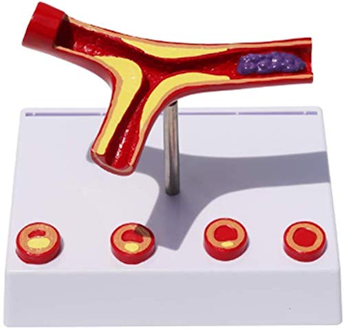 Buy Brands Educational Model Anatomy Atherosclerosemo Model - Thrombus ...