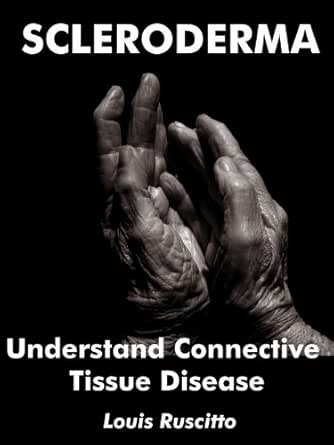 Scleroderma - Understand Connective Tissue Disease eBook : Ruscitto ...