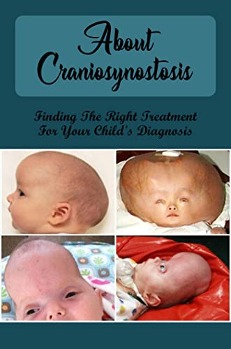 About Craniosynostosis: Finding The Right Treatment For Your Child's ...