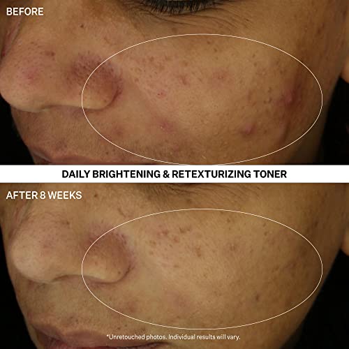 Multi-Action Clear Daily Brightening & Retexturizing Toner for Blemish ...