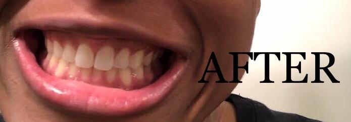 Amazon.com : POPWHITE Purple Power Duo Natural Teeth Whitening with 4 ...