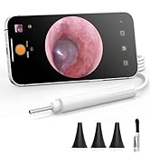 Amazon.com: ScopeAround Digital Otoscope w/IPS Screen, 720p HD Smart ...