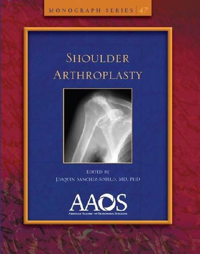 Shoulder Arthroplasty: 9780892038565: Medicine & Health Science Books ...