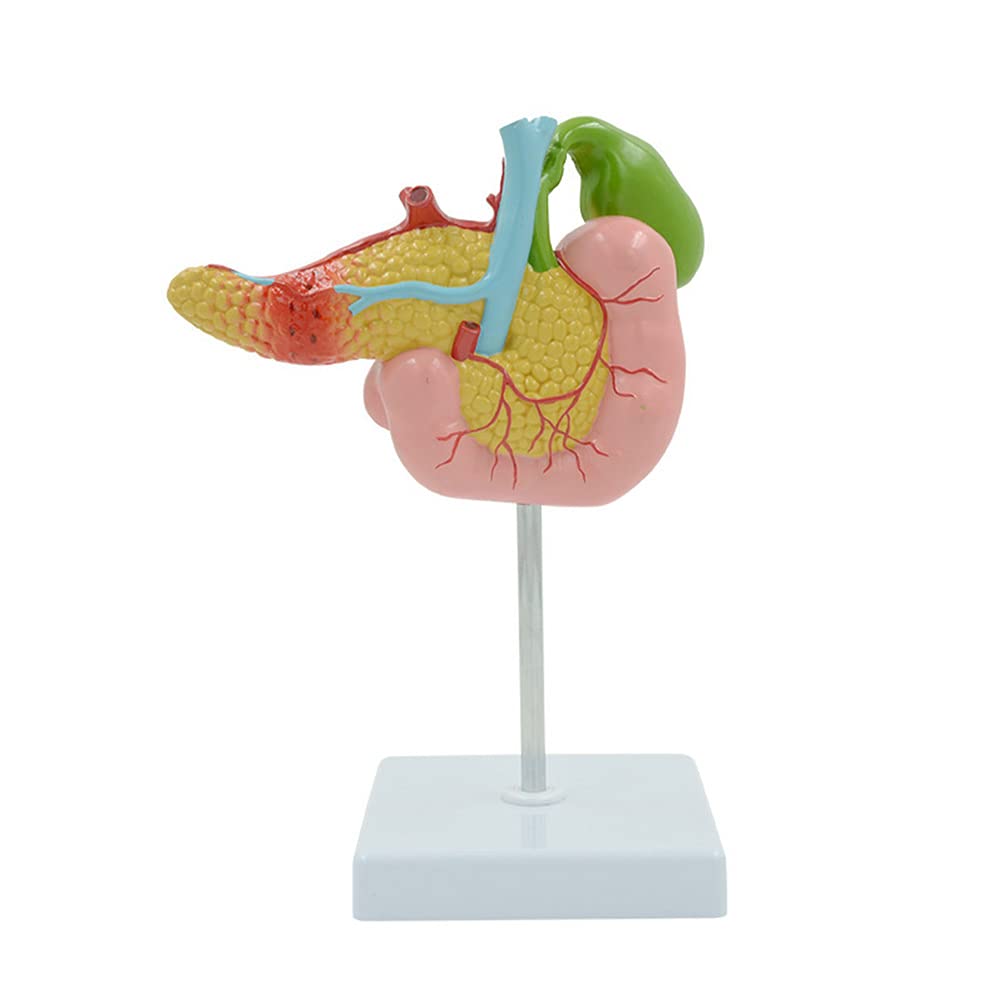 Buy Diseased Pancreas, Spleen, Hepatobiliary And Duodenum Model ...