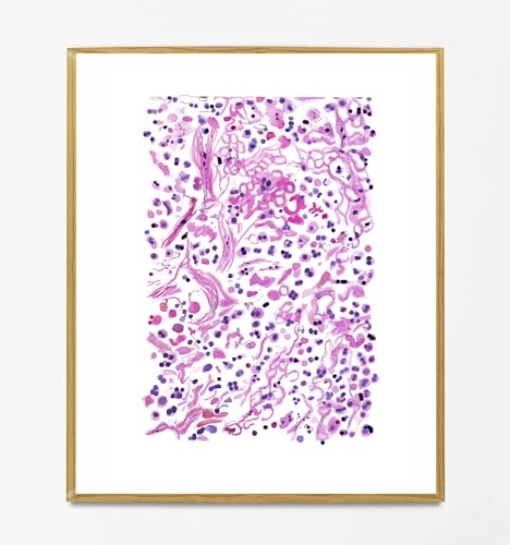 Amazon.com: Pneumonia Histology Pathology Art, Pathology Assistant ...