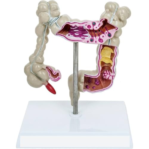 ARTSY Large Intestine Pathology Model : Amazon.in: Industrial & Scientific