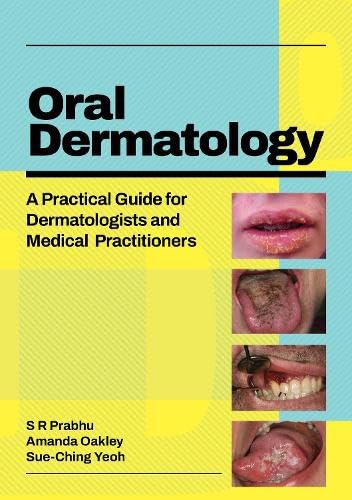 Oral Dermatology: A practical guide for dermatologists and medical ...