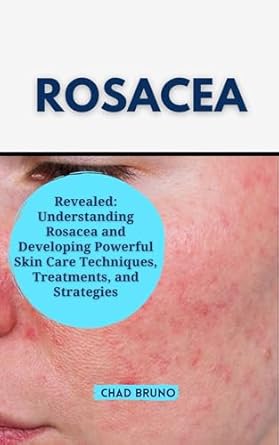 Amazon.co.jp: ROSACEA : Revealed: Understanding Rosacea and Developing ...
