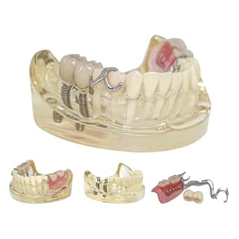 Amazon.com: Dental Implant Study Model Removable Partial Dentures RPD ...