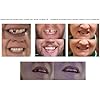 CREADENT Kit for Replacing a Missing Tooth with a Temporary Cosmetic ...