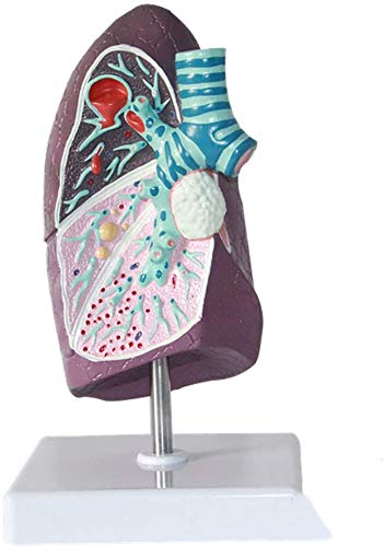 Buy LBYLYH Lung Model, Anatomical Model Of Human Lung Lesions (Lung ...