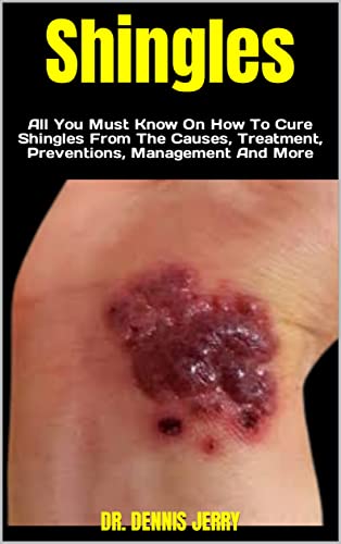 Shingles : All You Must Know On How To Cure Shingles From The Causes ...